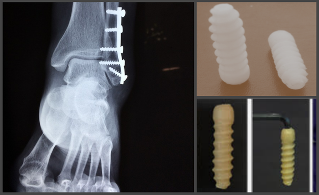 "Make in India" biodegradable screws for fixing bone injuries ...